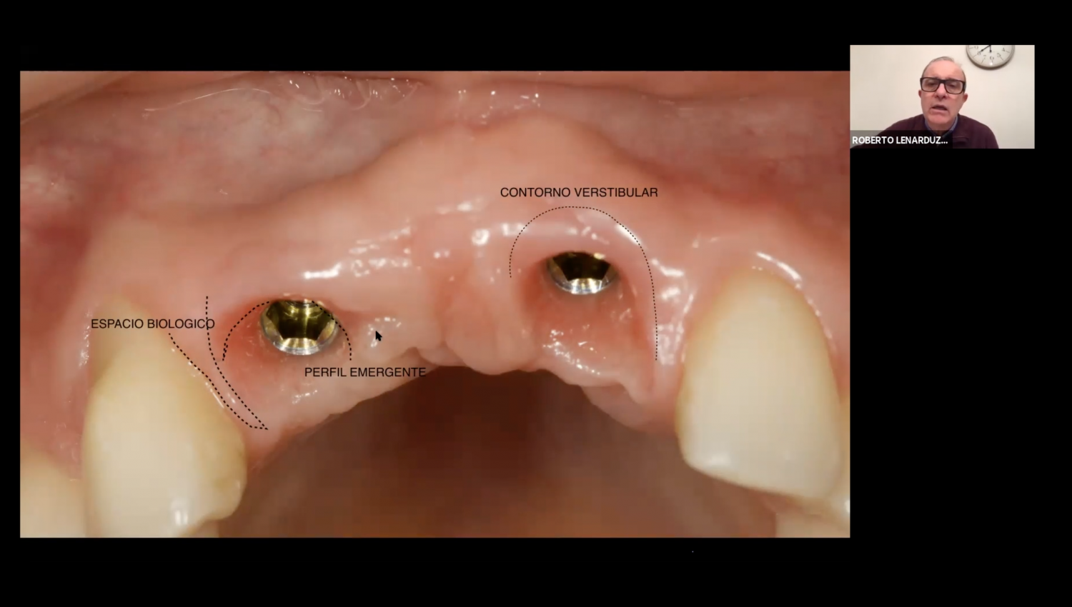 Zoom Live! – “Immediate Implants. Immediate Load” – Dr. Roberto ...